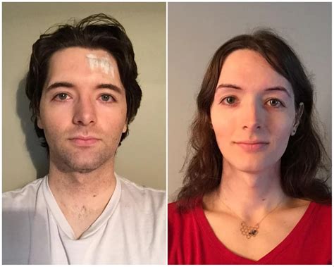 Mtf 15yr Hrt 27yo In 1 Week Bottom Surgery In 5 Day