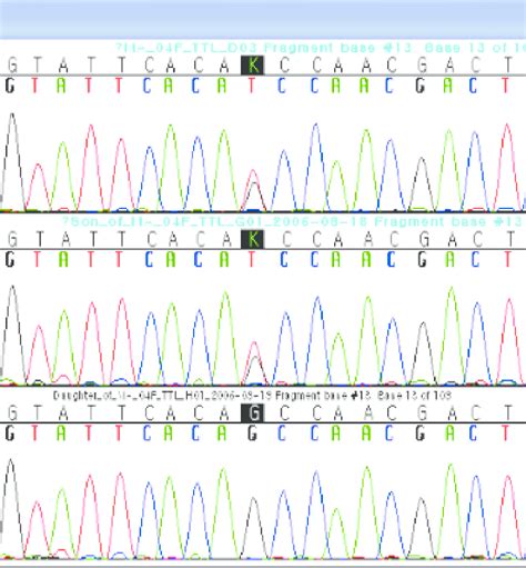Dna Sequence Chromatogram Showing Mutation In Exon 4 Of The Download Scientific Diagram