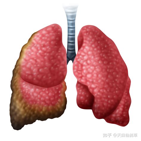 肺癌治疗新希望！替雷利珠单抗显著延长生存期，单药联合都有效，虽有不足但未来可期 知乎