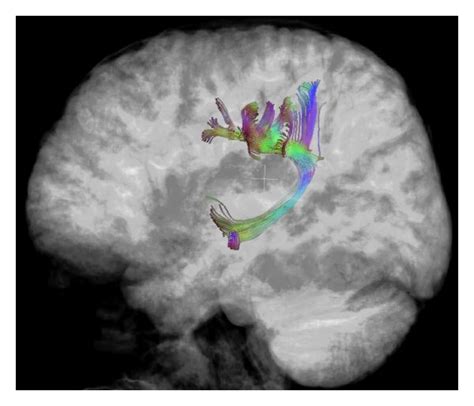 Left Lateral A And Posterior B Views Of The Arcuate Fasciculus Af Download Scientific