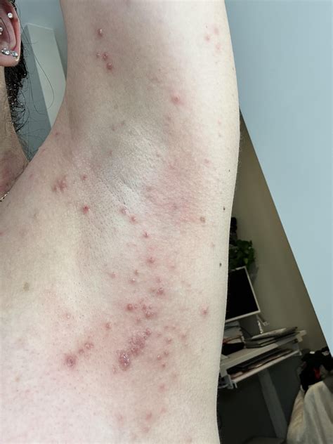 Is This Folliculitis Rfolliculitis