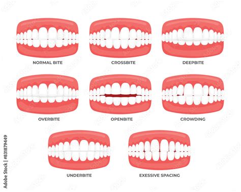 Set Of Malocclusion Types Set With Side View Of Normal Misalignment And Incorrect Relation