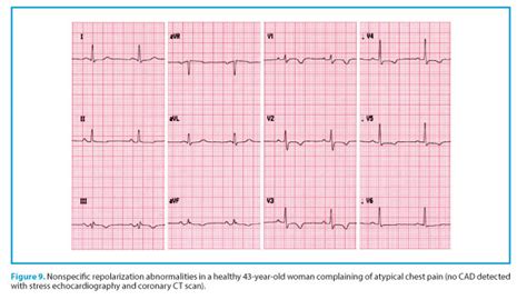 Gender Differences In The 12 Lead Electrocardiogram Clinical