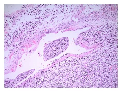 Microscopic Findings Of The Right Axillary Mass Showed Diffuse Sheets