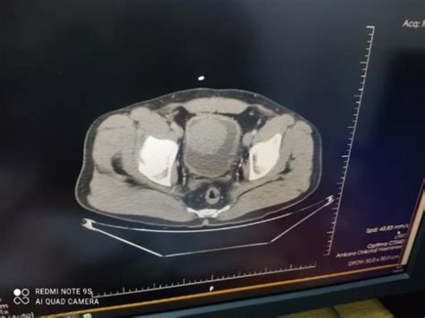 A Nodular Enhancing T2b Tumor In The Bladder Lumen Shown In Axial Download Scientific Diagram