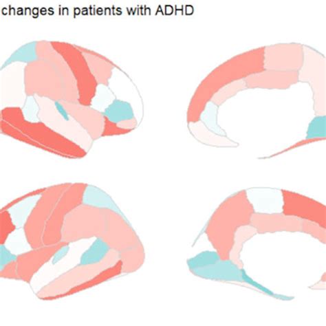Machine Learning Used With Mri Shows Promise For Adhd Diagnosis