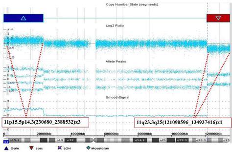 Duplication And Deletion At 11p And11q In This Patient Demonstrated By
