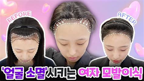 얼굴 소멸 시키는 여자 모발이식 비절개 3000모대 모발이식 후기 모모성형외과 Youtube