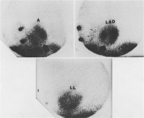 Resting Thallium 201 Myocardial Scan With A Focal Defect In The