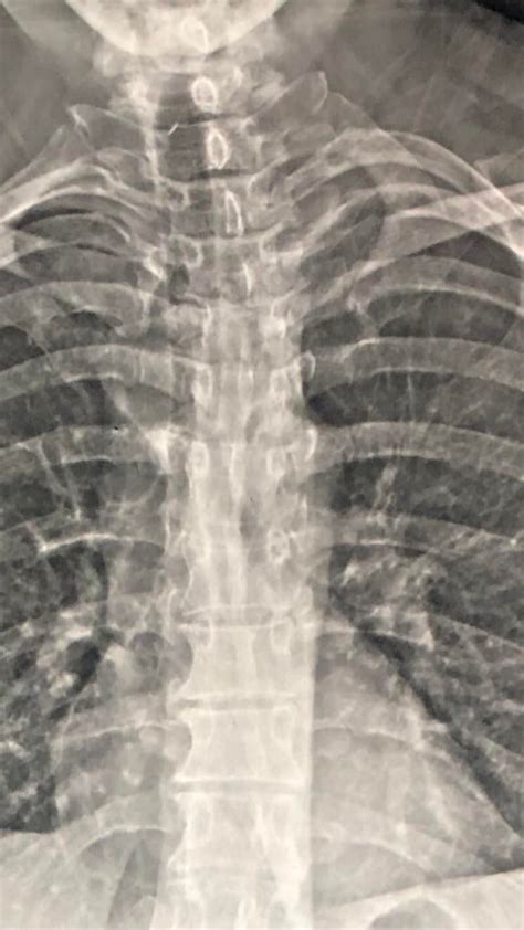 Spinal Curve Rmedical