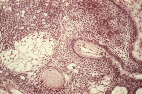 Brain Tumour Light Micrograph Stock Image C023 5658 Science Photo Library