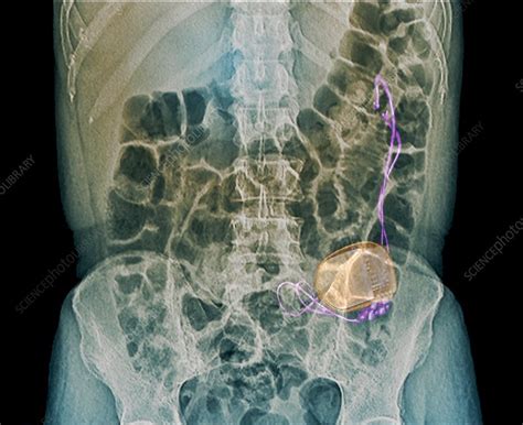 Gastric Pacemaker In Gastroparesis X Ray Stock Image C029 9952 Science Photo Library