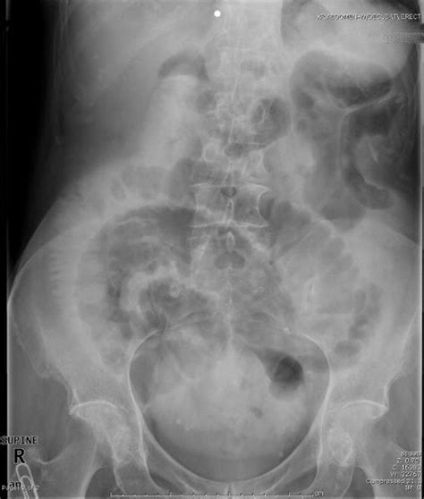 Image Small Bowel Obstruction Supine Radiograph Msd Manual