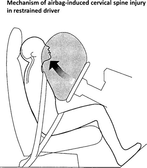 What Is Restrained Driver At Sean Goss Blog