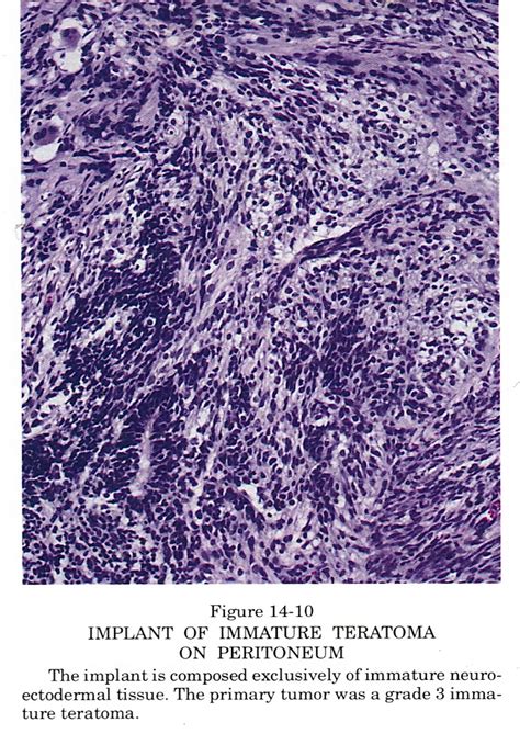 Pathology Outlines Teratoma Immature