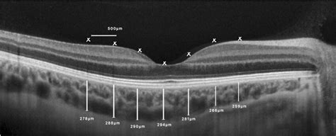 Representative Oct Choroidal Measurement Analysis Of Pediatric Ht Patients Download Scientific