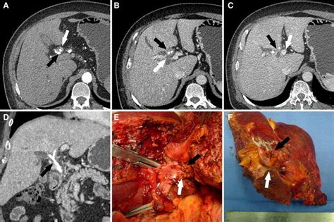 Mdct Scans In A 57 Year Old Man With Hilar Cholangiocarcinoma After Download Scientific Diagram