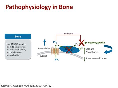 Hypophosphatasia Understanding The Disease And Improving Diagnosis Transcript