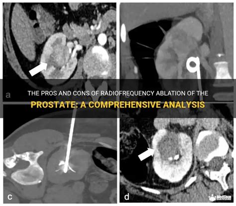 The Pros And Cons Of Radiofrequency Ablation Of The Prostate A