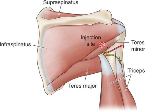 Intra Articular Joint Injections Anesthesia Key
