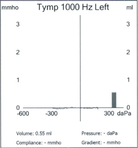 Tympanometry What It Is And Types Of Tympanogram Readings