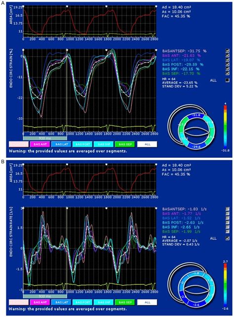 Diagnostic Accuracy Of Myocardial Deformation Indices For Detecting