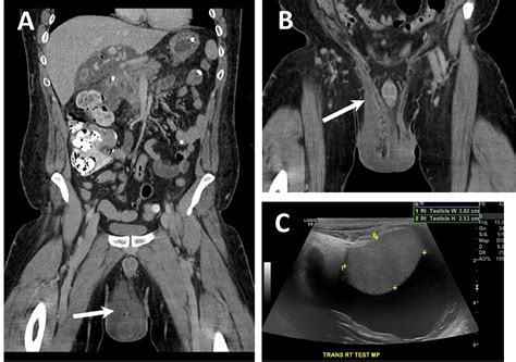 Enlarged Scrotum Hydrocele