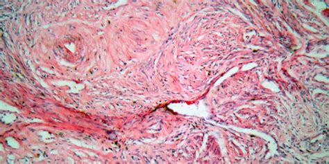 Asccp Discusses American Cancer Society Cervical Cancer Screening Guidelines Clinical Lab Products