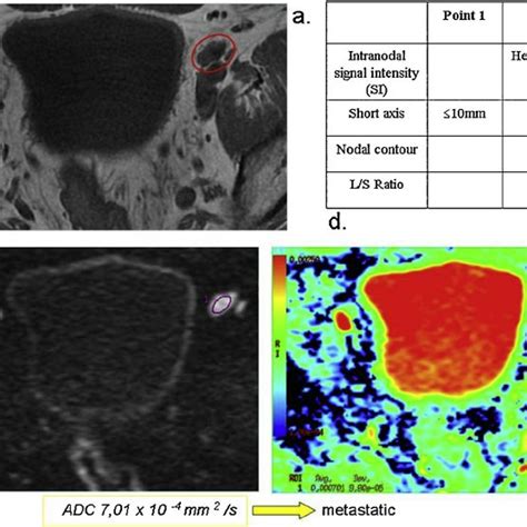 An Example Of Benign Lymph Node A T2w Image B Dw Image C Adc Download Scientific