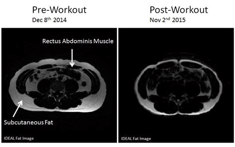 Weightloss After 1 Year Of Exercise On Mri Xpost R Fitness Imgur