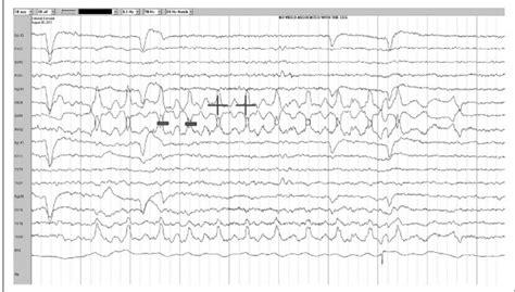 Artifact And Ambulatory Eeg Neupsy Key