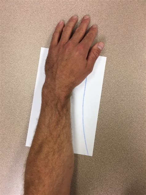 How I Healed My Subluxating Extensor Carpi Ulnaris Tendon And Homemade Splint Instructions