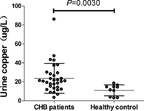 Urinary Total Copper Concentration In Patients With Chronic Hepatitis B