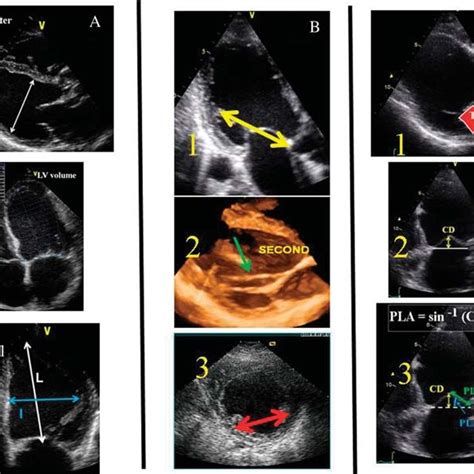 Mitral Valvular Segmentation Analysis With 2d Trans Download Scientific Diagram