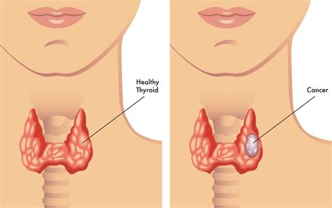 Papillary Thyroid Cancer Recurrence After Total Thyroidectomy