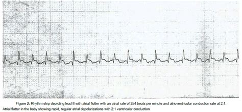 Fetal Tachycardia As Neonatal Atrial Flutter In Infant Of Diabetic Mother Idm A Case Report