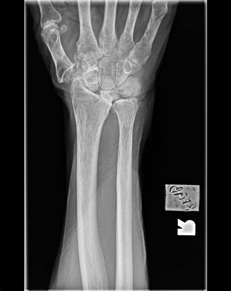 Wrist Imaging Treatment And Management Point Of Care