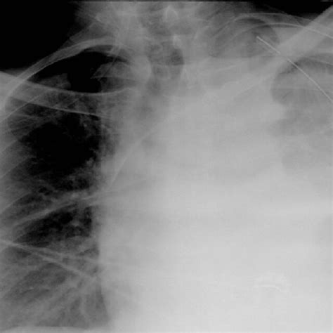 Initial Chest X Ray Showing A Left Tension Pneumothorax With Pleural