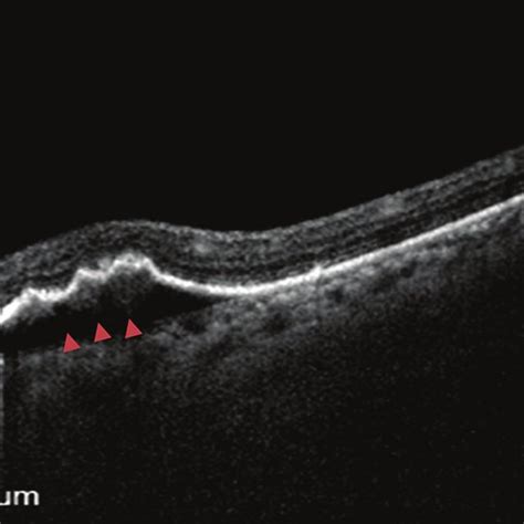 Enhanced Depth Imaging Spectral Domain Optical Coherence Tomography Download Scientific Diagram