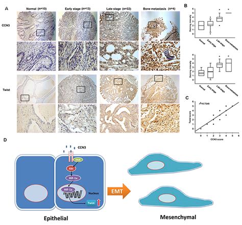 Ccn3 Promotes Epithelial Mesenchymal Transition In Prostate Cancer Via Fak Akt Hif 1α Induced