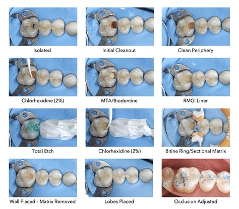 improve pulp capping success rate dr stevenson shows you how