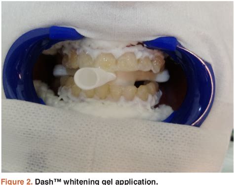 Figure 1 From Evaluation Of Post Bleaching Hypersensitivity Using Desensitizing Agent Before And