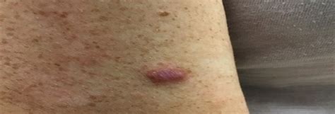Firm Nodule On The Right Upper Medial Arm Challenge The American