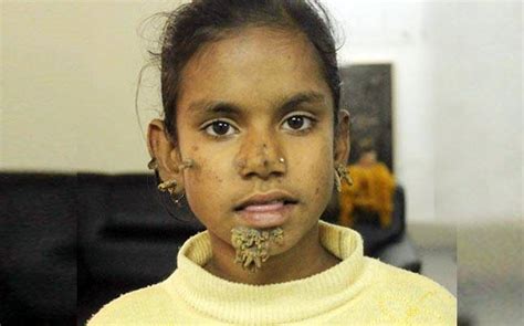 Bangladesh Girl Suffering From Tree Man Syndrome Successful