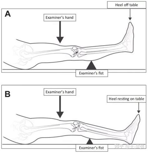 前交叉韧带（acl）损伤、检查、治疗 知乎