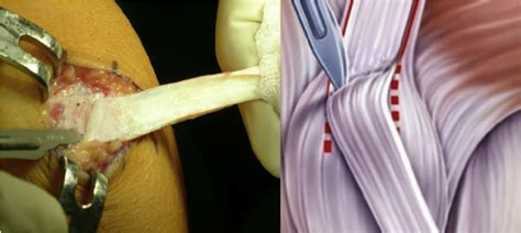From The Medial Patellar Border The Prepatellar Tissue Is Elevated