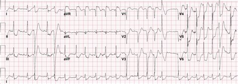 St Elevation In Avr With Diffuse St Depression An Ecg Pattern That You Must Know And Understand