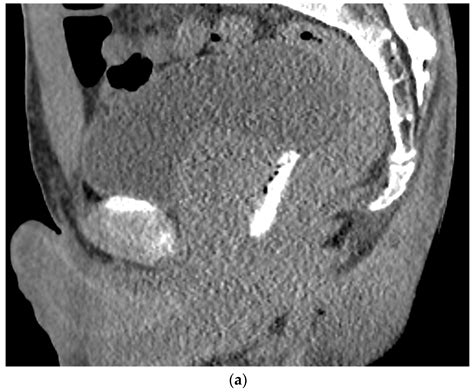 Hydrogel Spacer Spaceoar Vue For Prostate Radiotherapy Encyclopedia Mdpi