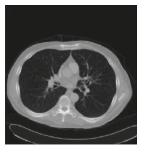 Ct Image After Binarization Processing A The Initial Ct Image B