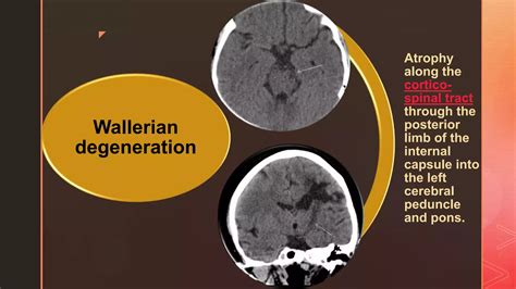 Stroke Classification Bamford Oxford Geeky Medics Artofit